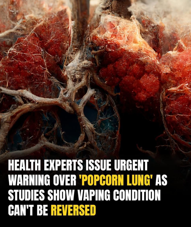Urgent Alert: Vaping-Linked ‘Popcorn Lung’ Causes Lasting Harm, Experts ...